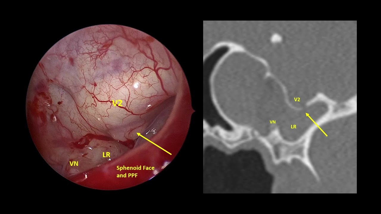 Easier and Better for Lateral Recess Encephaloceles - YouTube