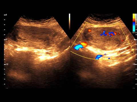 Partial Molar Pregnancy | GESTATIONAL TROPHOBLASTIC | Hydatidiform ...