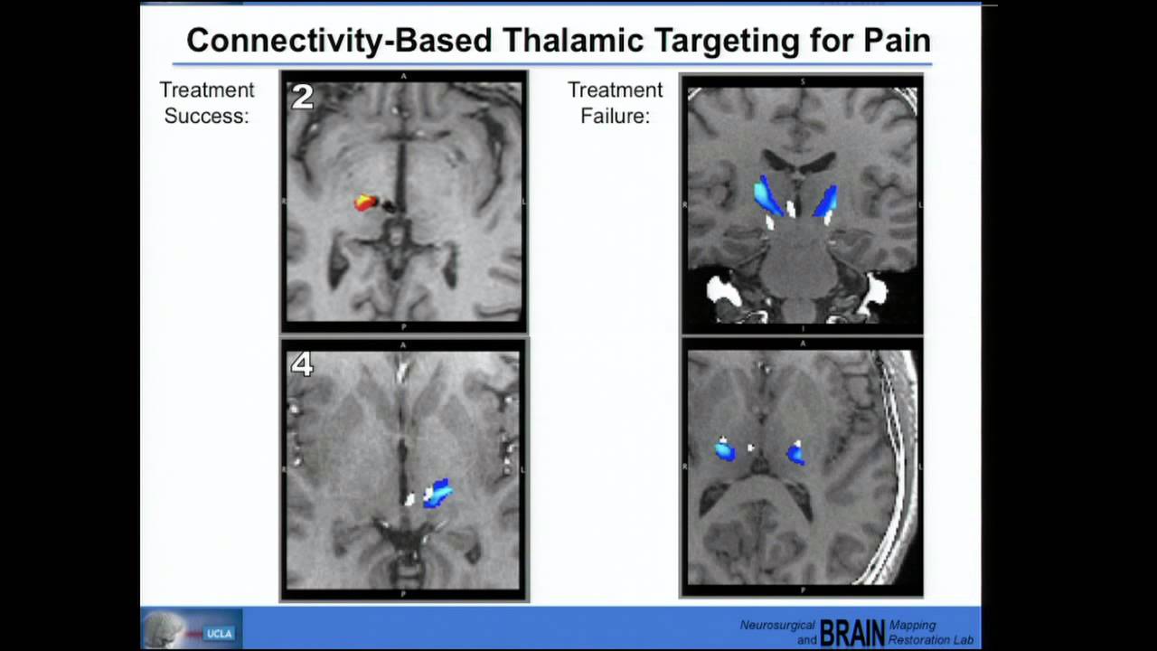 Neural Prosthesis Seminar, Nader Pouratian, MD, PhD - YouTube
