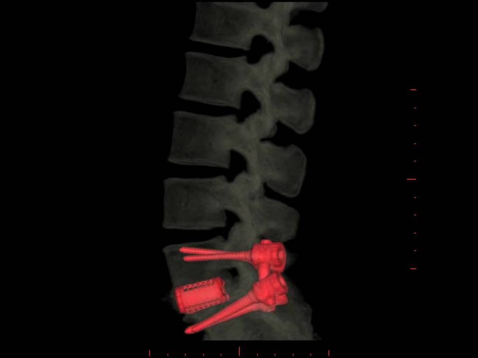 MDI Radiology - CT lumbar spine 3D - YouTube