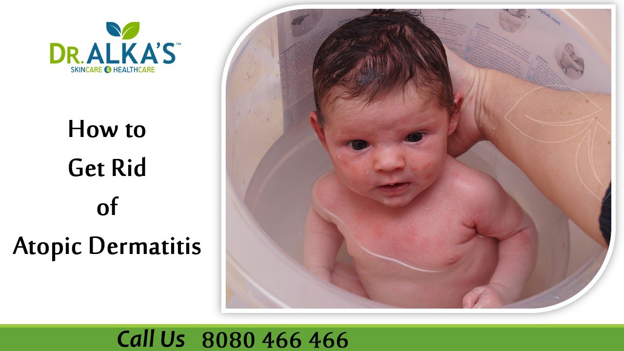 How to Get Rid of Atopic Dermatitis - YouTube