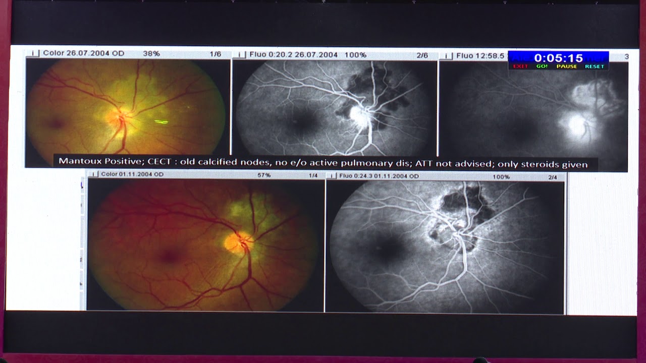 AIOC2020 GP160 T3 Dr Vishali Gupta Tubercular Posterior Uveitis Current ...