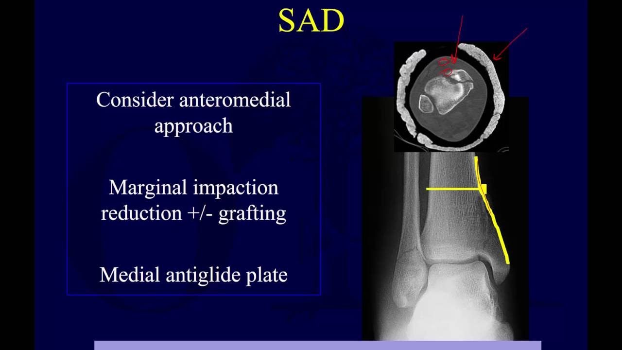 Malleolar ankle fractures - Lauge Hansen types (OTA lecture series III ...