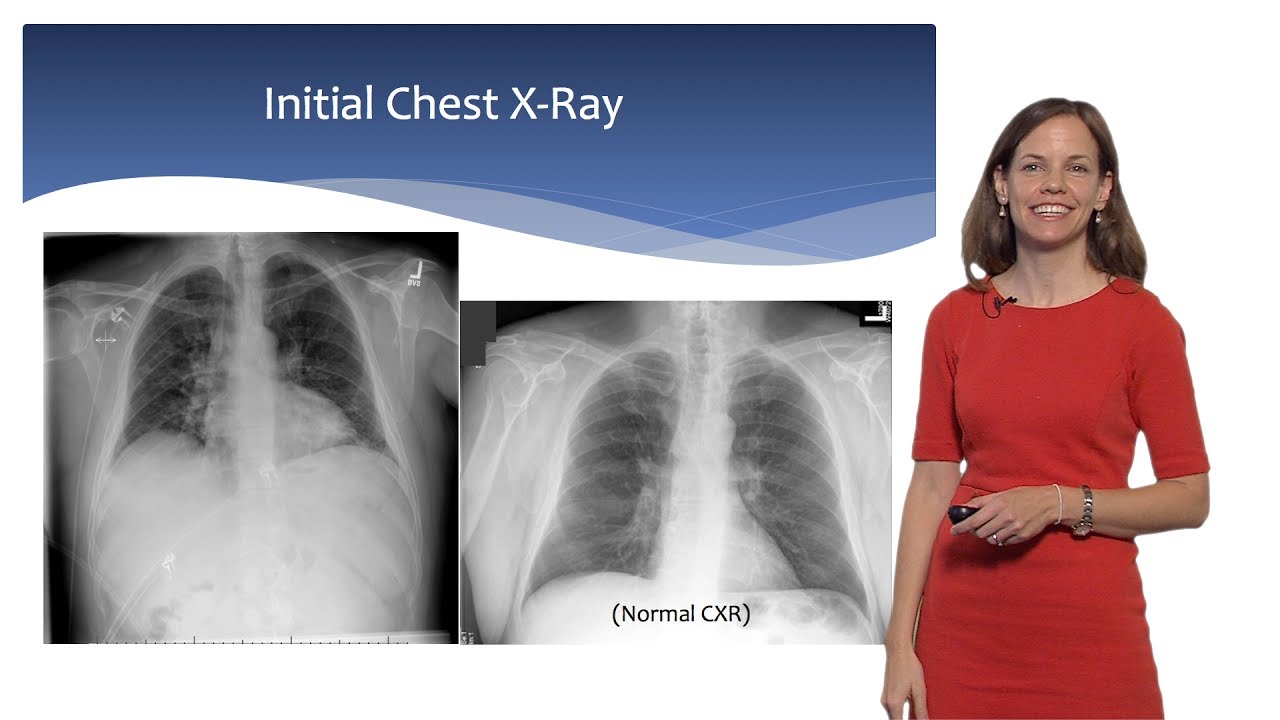 Ards Chest X Ray