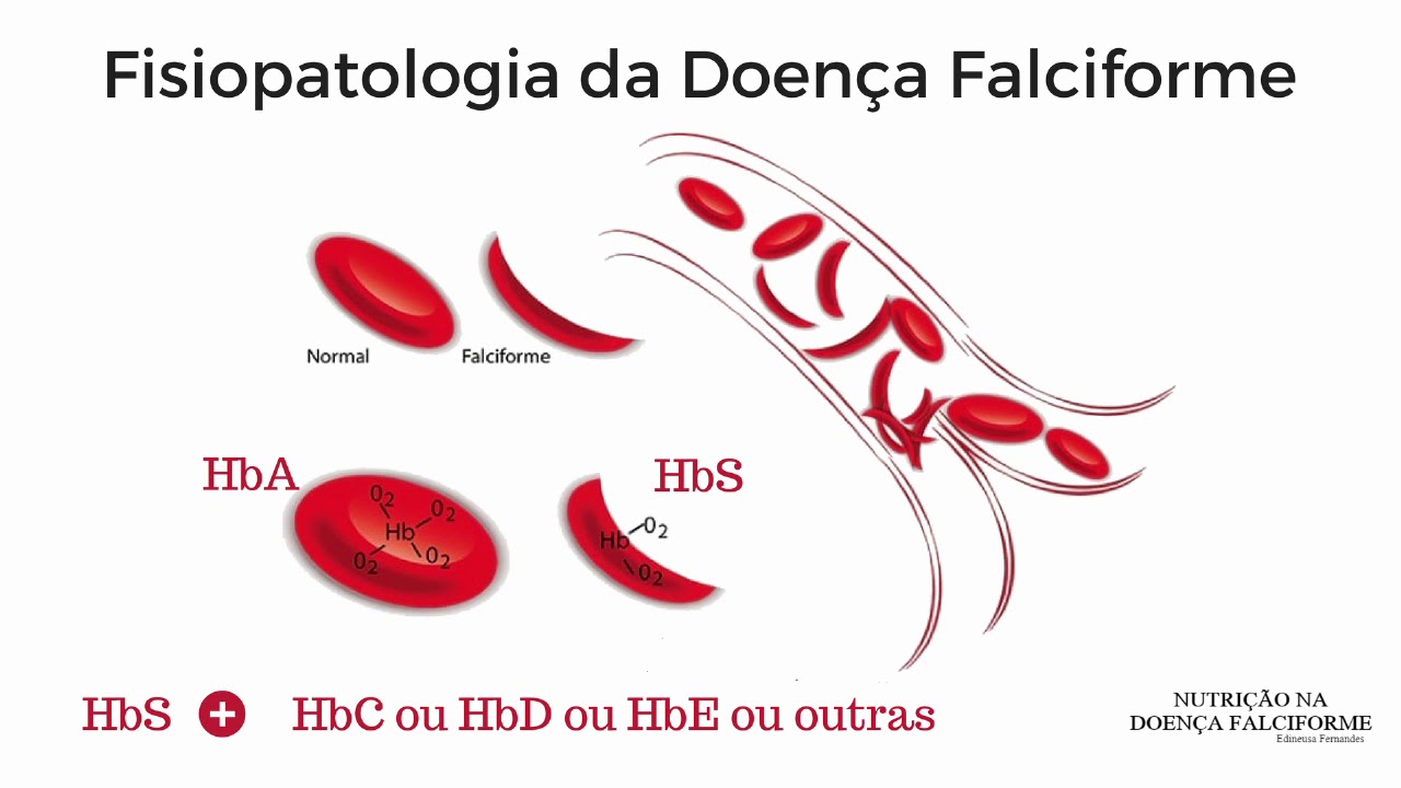 Fisiopatologia da Doença Falciforme - YouTube