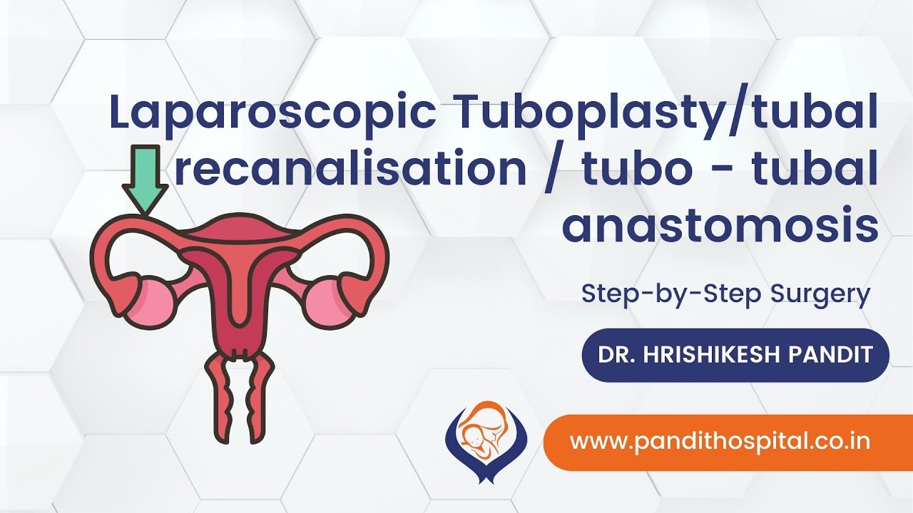Laparoscopic Tuboplasty/ tubal recanalization / tubo -tubal anastomosis ...