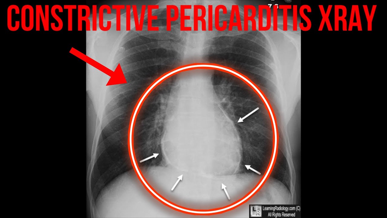 CONSTRICTIVE PERICARDITIS | XRAY FINDINGS | ALL DIFFERENTIALS - YouTube