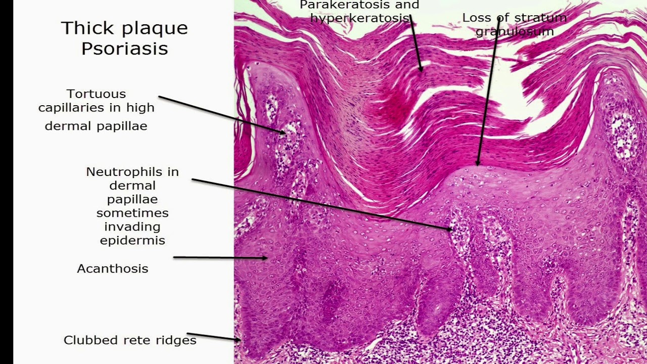 Auspitz Sign - YouTube