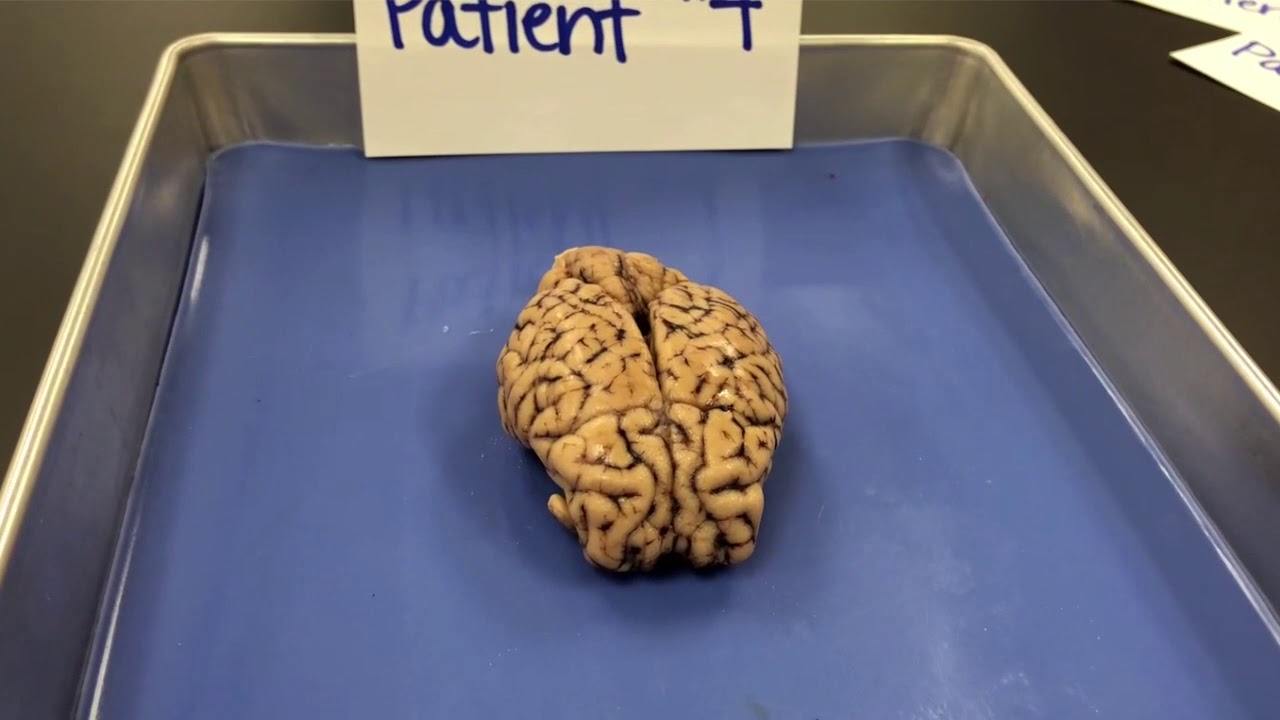 Brain Autopsy Lab Patient 4 - YouTube