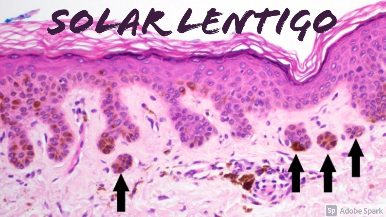Lentigo Maligna Melanoma Histology