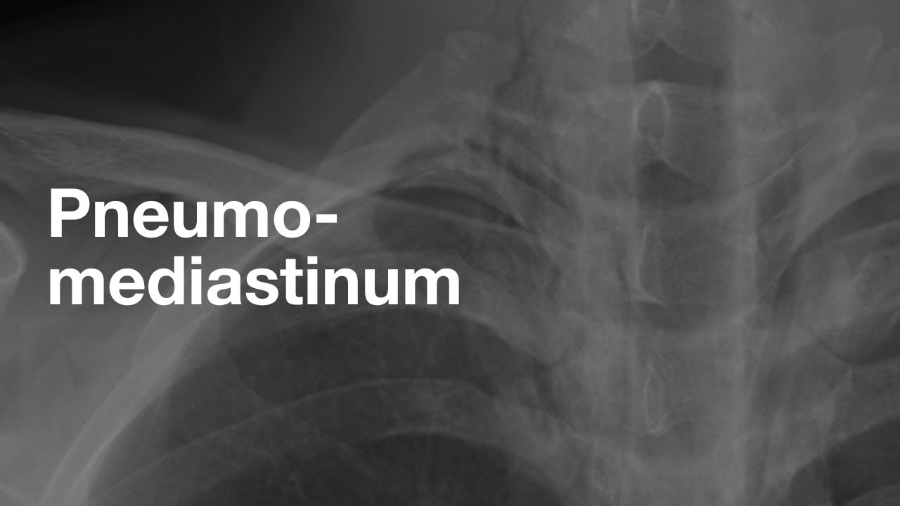 Pneumomediastinum - YouTube