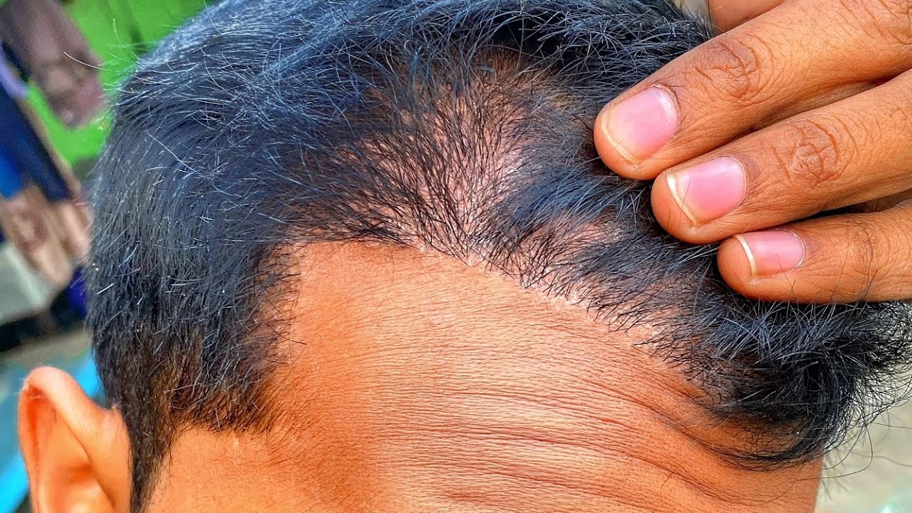 My Hair Transplant Failed 😢 | Hair Transplant - YouTube