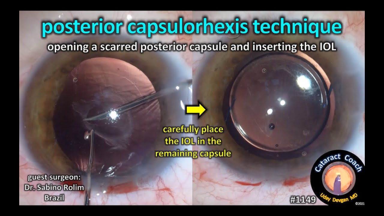 CataractCoach 1149: posterior capsulorhexis in cataract surgery - YouTube