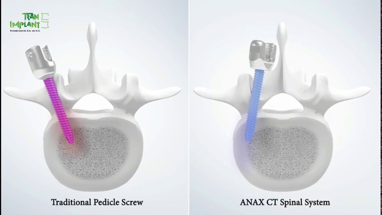 ANAX 5 5 CT Spinal System - YouTube