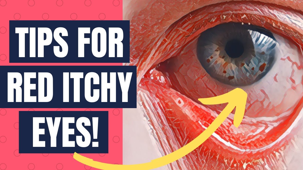 How To Get Relief From Allergic Conjunctivitis or Itchy Red Eyes - YouTube