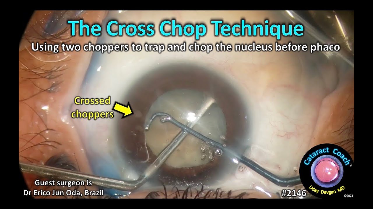 CataractCoach™ 2146: the cross chop technique - YouTube