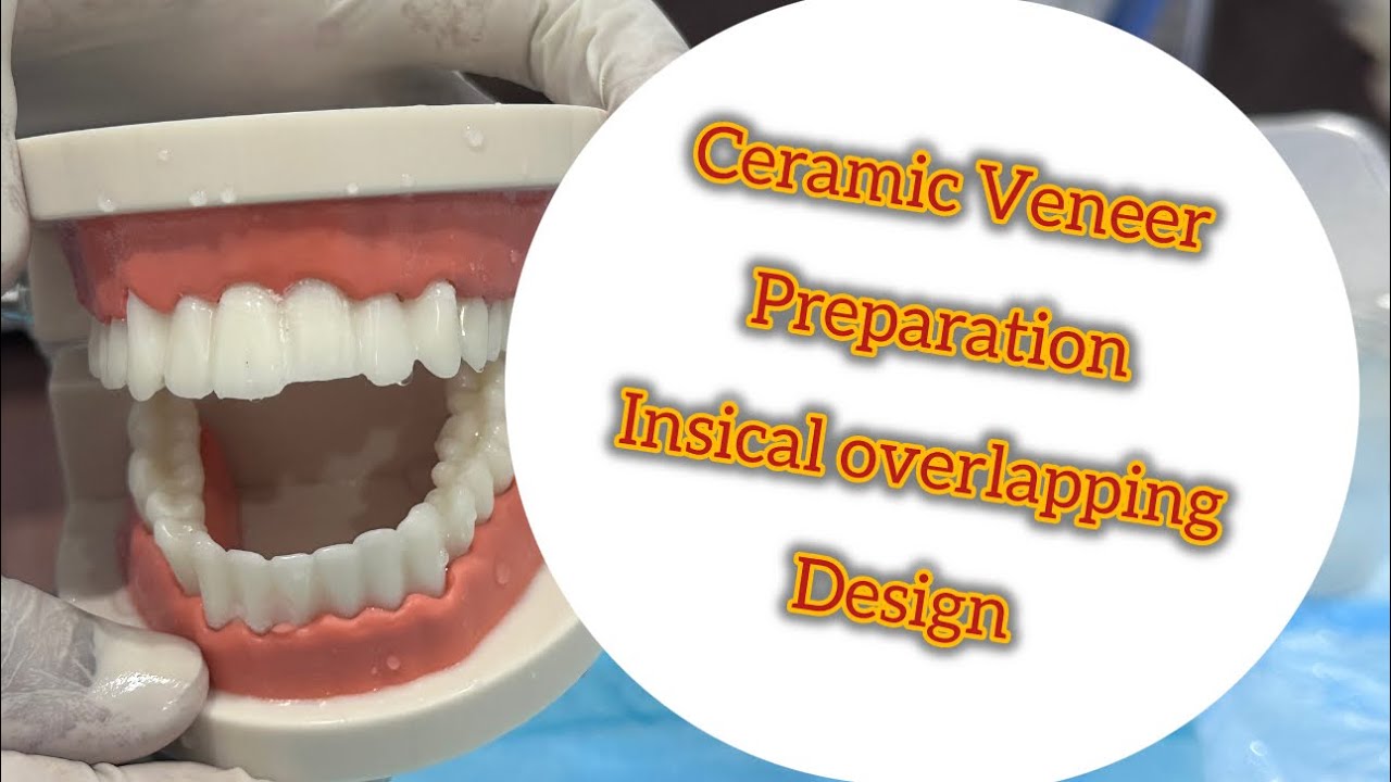 Dental Veneers Preparation Guidelines - YouTube
