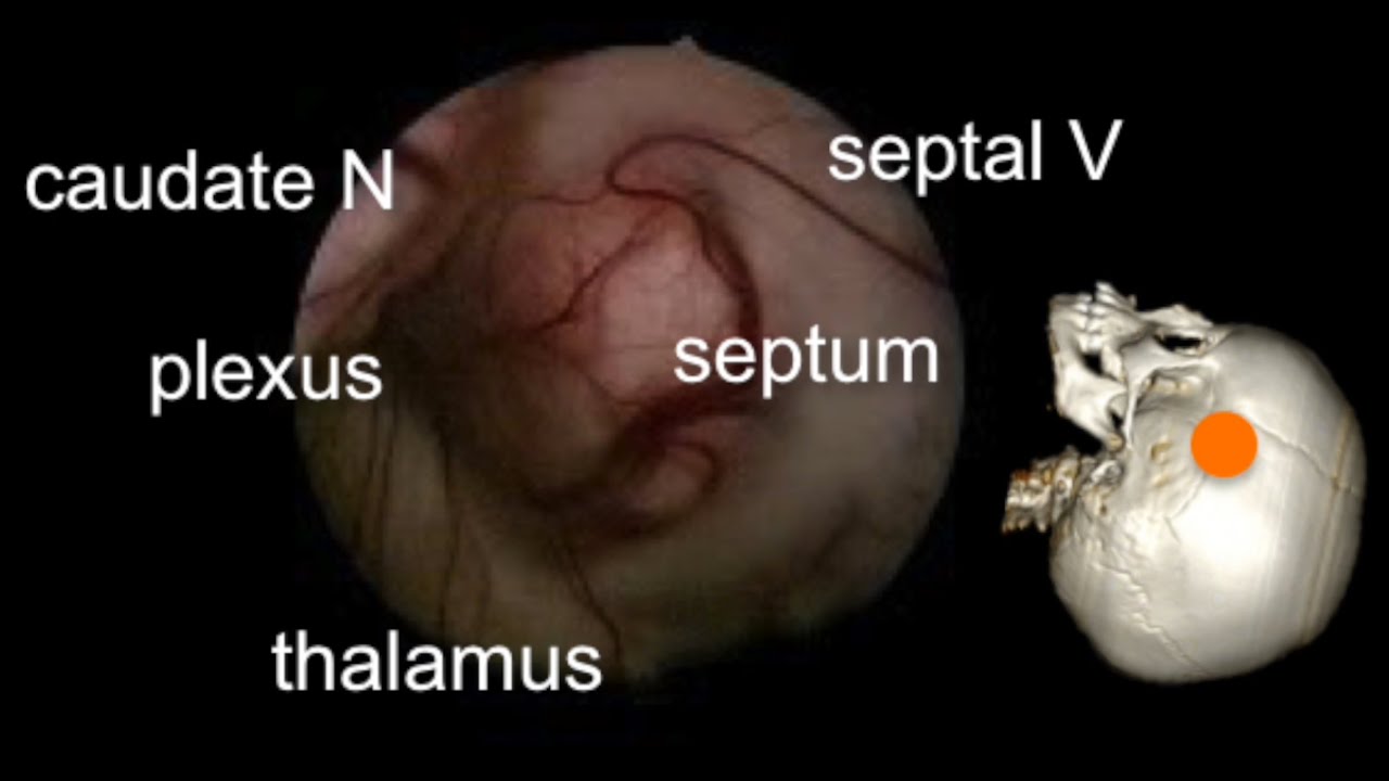 septostomie endoscopique - YouTube