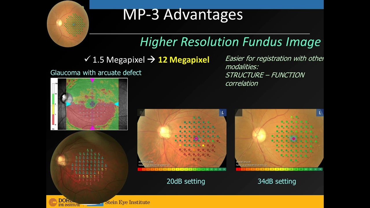 Nidek MP-3 Microperimeter & RS-3000 OCT - YouTube