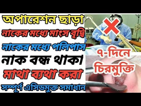 How to Cure Nasal Polyps Permanently and Naturally -Get Rid of Nasal ...