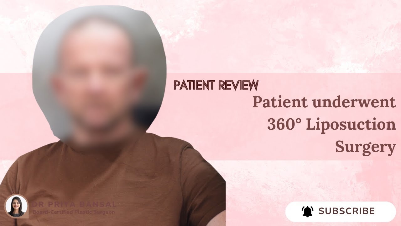 360° Liposuction Surgery Patient Review | Liposuction Surgery Patient ...
