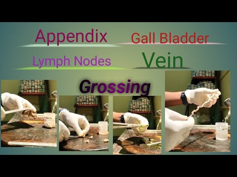 Grossing| Appendix| Gall Bladder| Lymph nodes| Vain Grossing ...