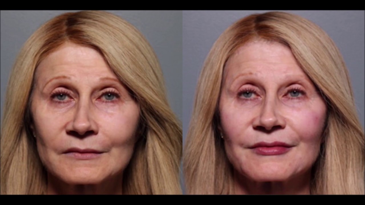 Dr. Nino Kuzmar Performs MD Codes™ Injection Technique Mini Video - YouTube