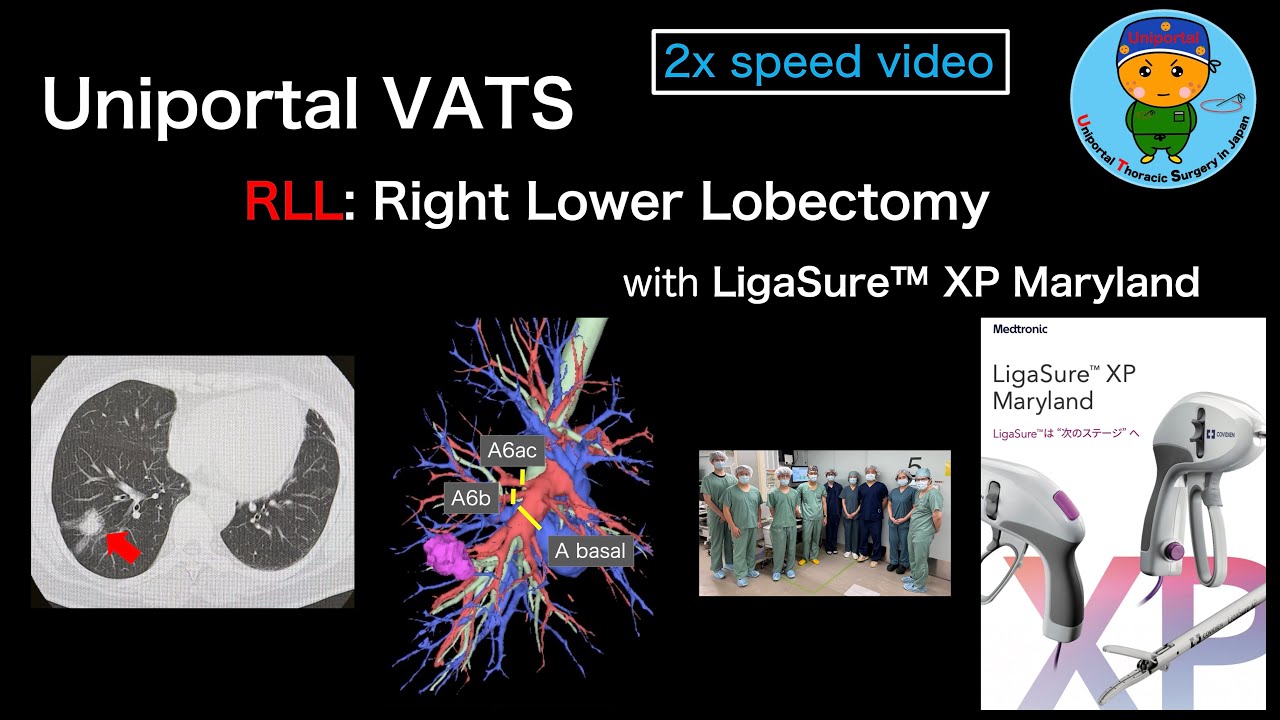 144】Uniportal VATS Right Lower Lobectomy (ND2a-1) with LigaSure™ XP ...