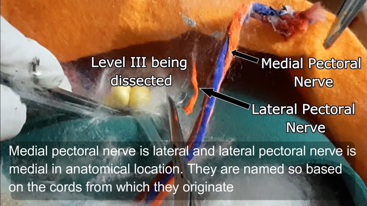 Mastectomy with Axillary dissection for Breast cancer - How I do it ...