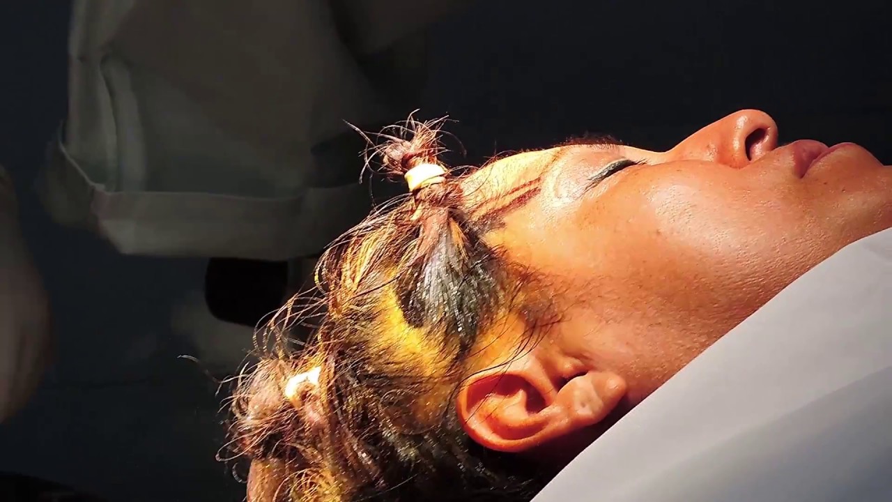 Cirugía de Lifting de Cejas - Dr César Calderón Cirujano Plástico - YouTube