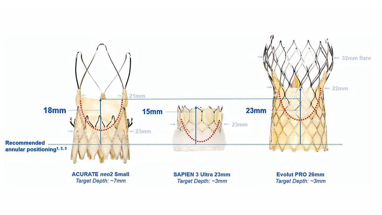 TAVI: from first valve to lifetime management - Webinar - YouTube