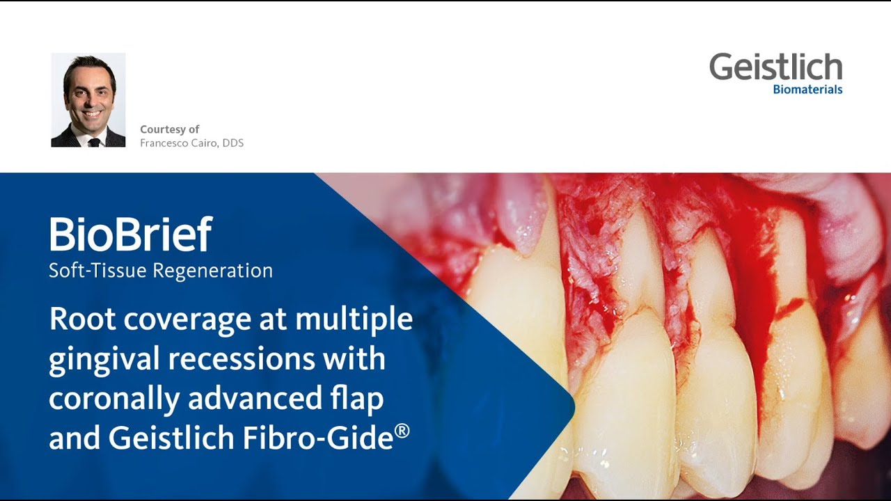 Root coverage at multiple gingival recessions with coronally advanced ...
