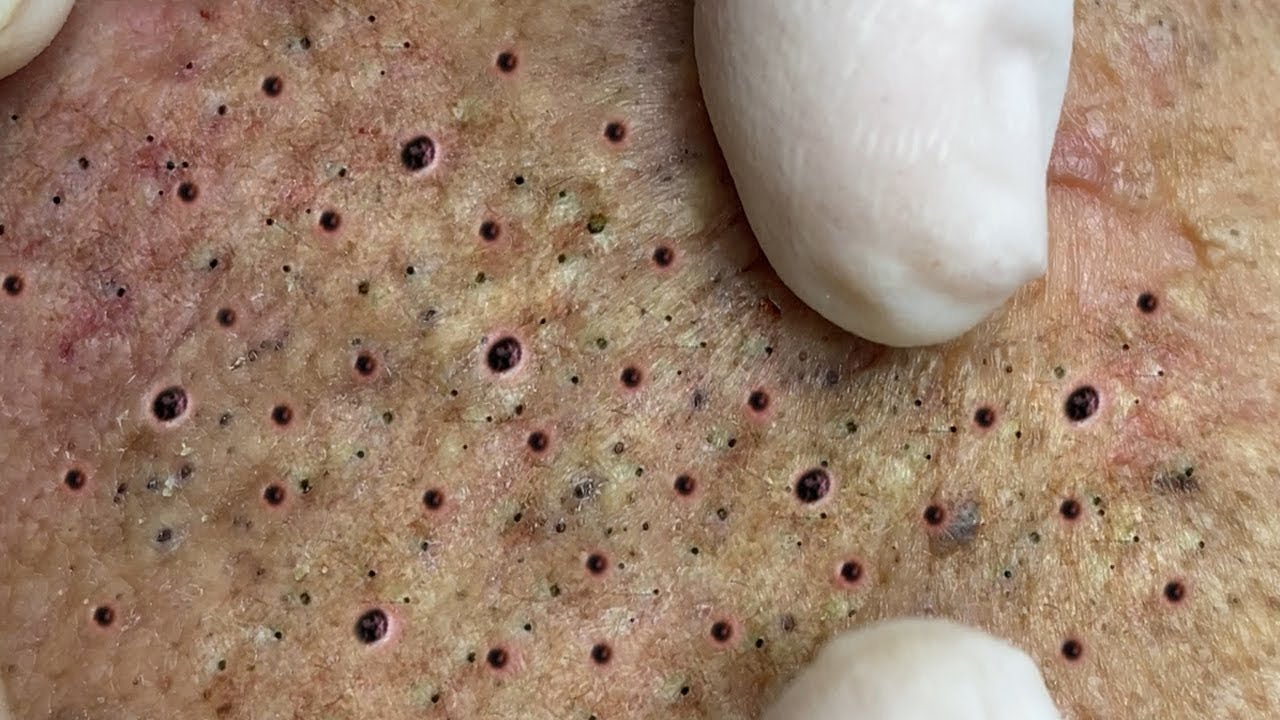 Blackheads & Acne Treatment 26.04.2024 (Part 9) - YouTube