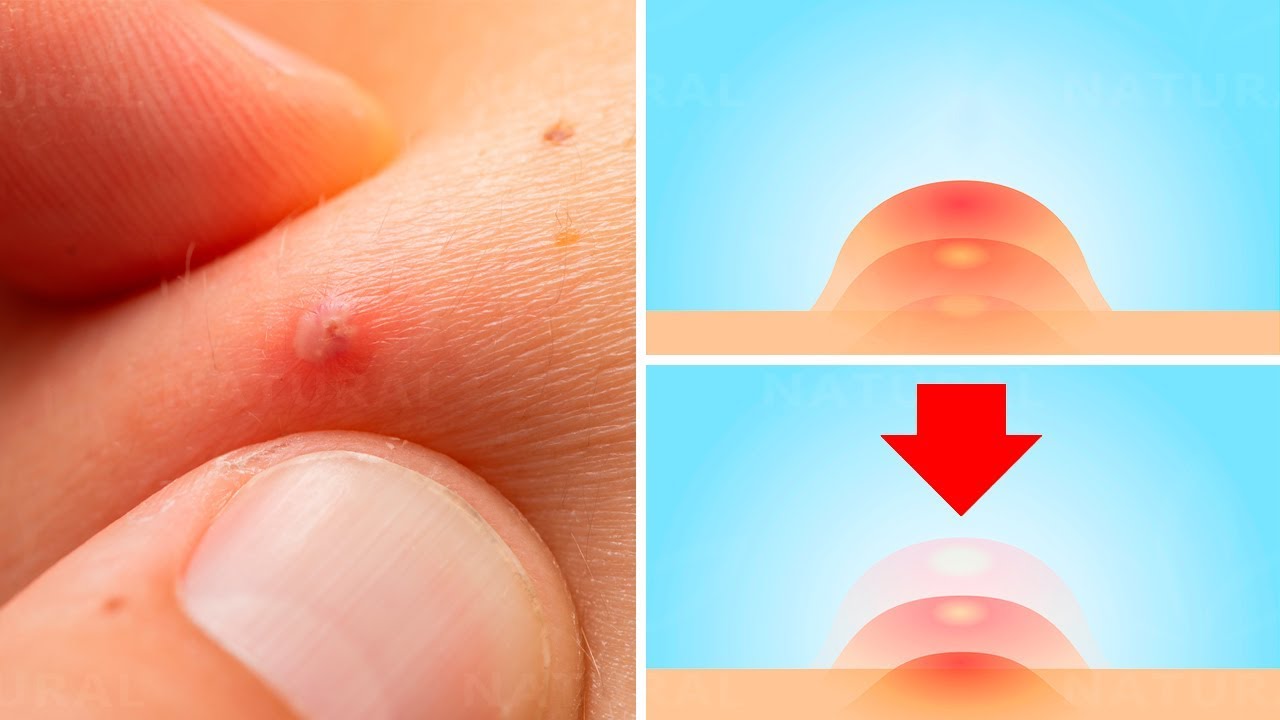 How To Get Rid Of Pimples At Home YouTube how-to-get-rid-of-pimples-at-home-youtube