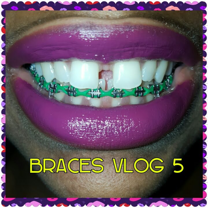 Braces Vlog 5 | 4 Month Update - YouTube