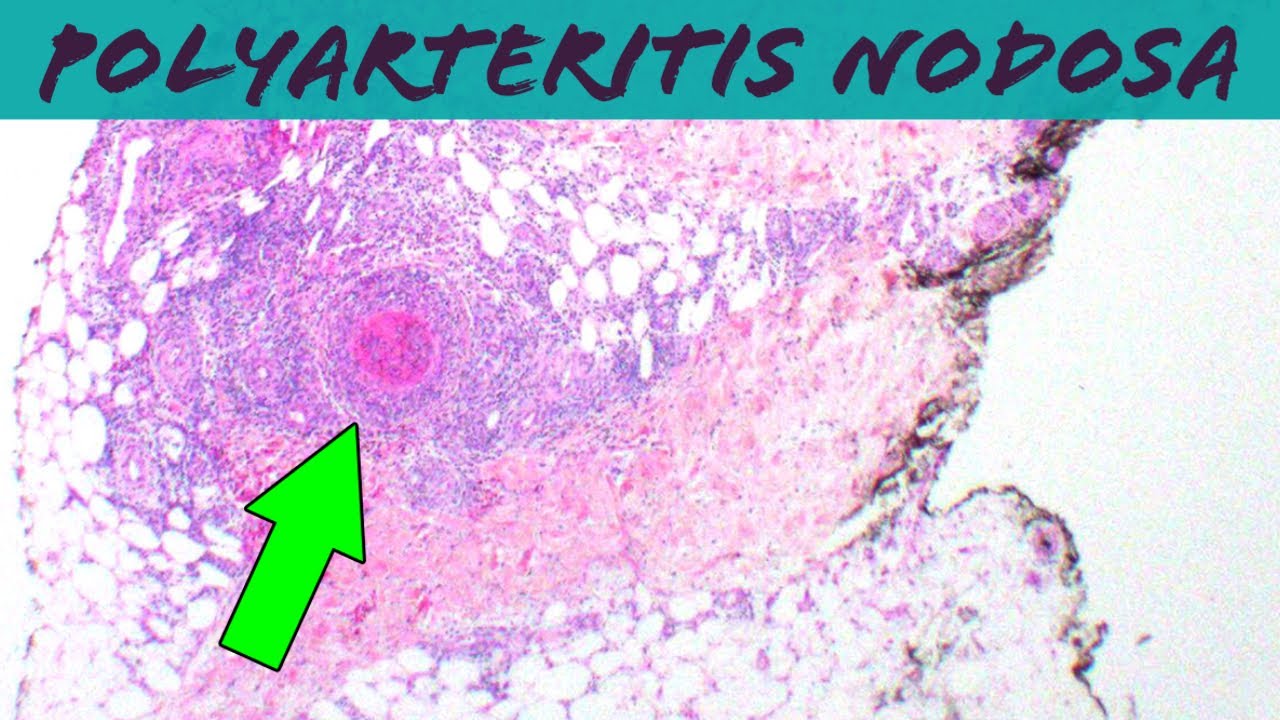 Polyarteritis Nodosa (vasculitis pathology dermpath dermatology usmle ...