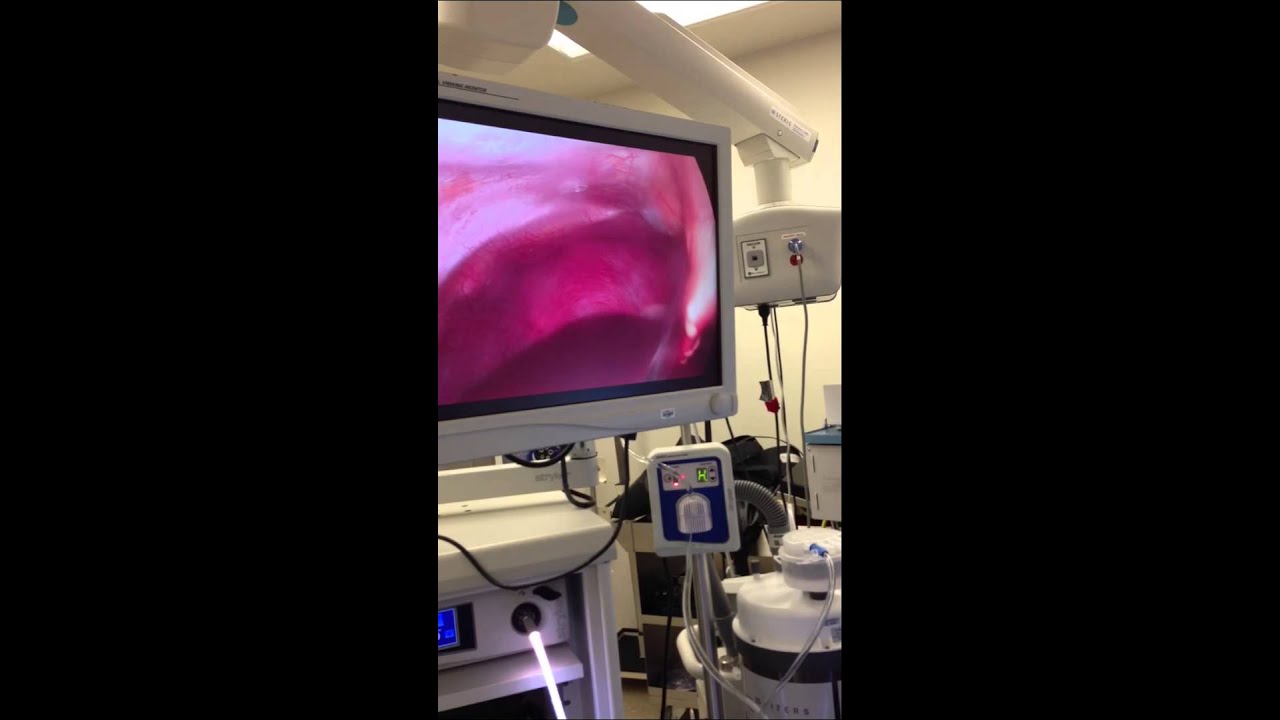Laparoscopic Local Infiltration Technique - YouTube