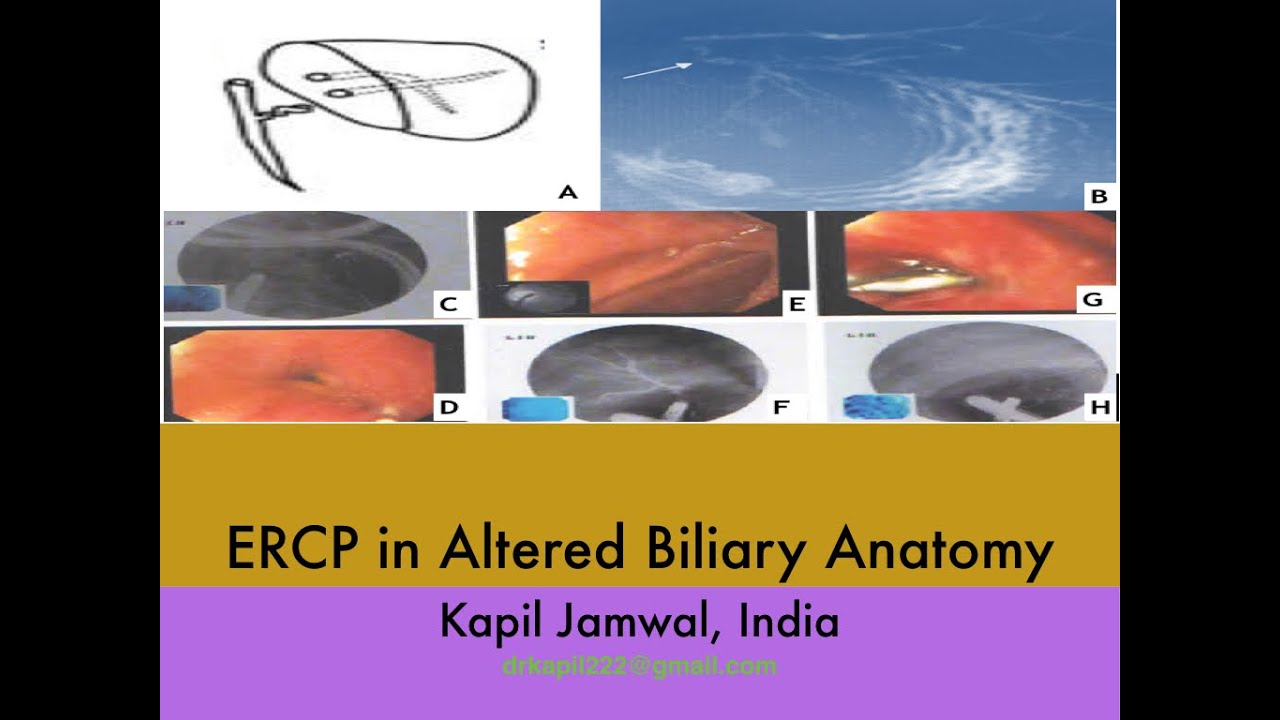 ERCP in altered anatomy / ERCP in Bill roth II/ ERCP in roux en y ...