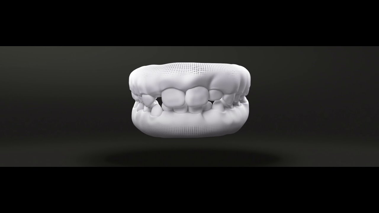 Dentition mixte et les aligneurs - YouTube