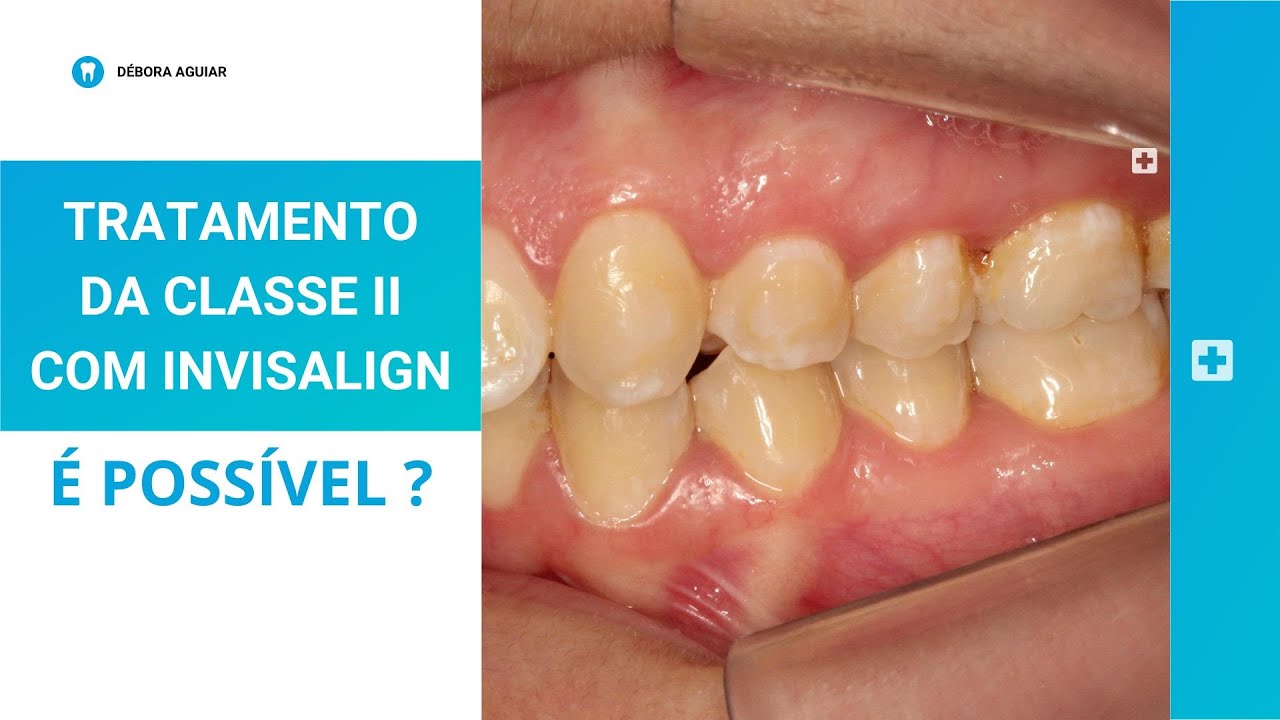 TRATAMENTO DA CLASSE II COM INVISALIGN: Aprenda a planejar com ...