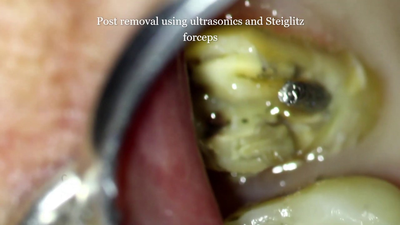 post removal root canal retreatment ul6 - YouTube