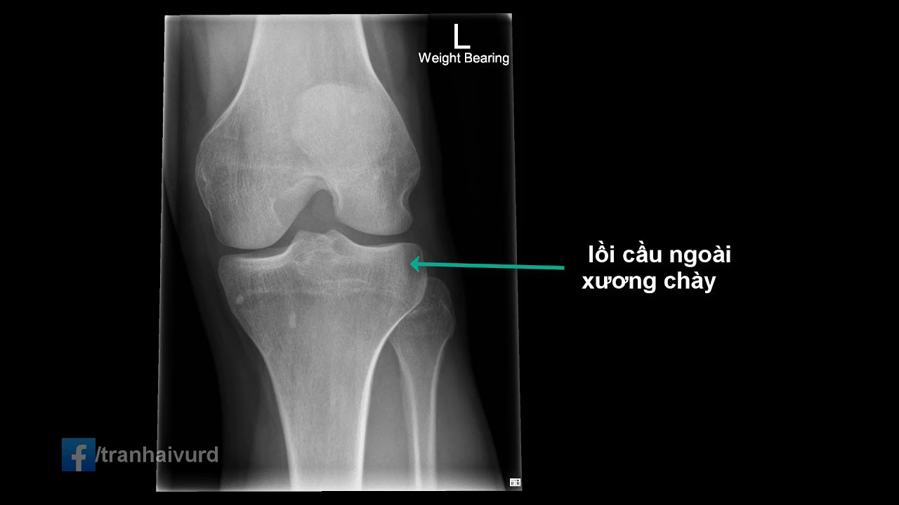 Xquang khớp gối | Tran Hai Vu the Radiologist - YouTube