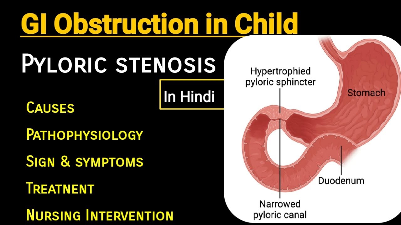 GI obstruction | Hypertropic pyloric stenosis,pathophysiology,sign ...