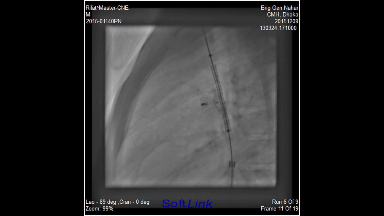Rifat PDA Device + COA Stenting - YouTube