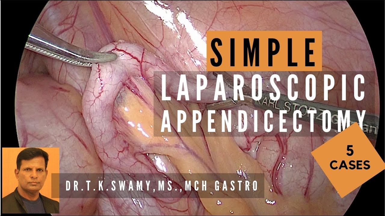 Simple Laparoscopic Appendicectomy- 5 cases - YouTube