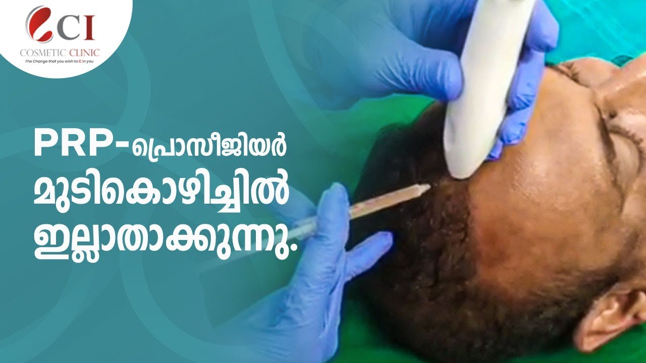 PRP പ്രൊസീജിയർ മുടികൊഴിച്ചിൽ ഇല്ലാതാക്കുന്നു! - YouTube