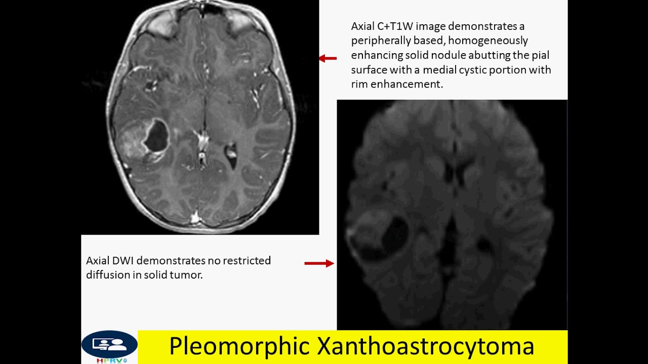 Pleomorphic Xanthoastrocytoma - YouTube