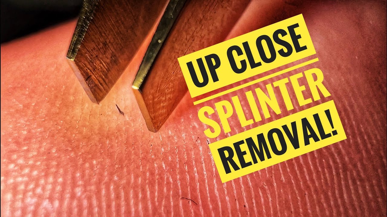 Splinter Removal, Extremely Satisfying! - YouTube