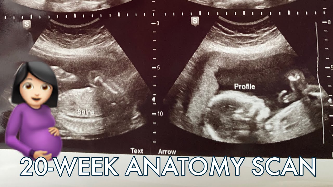 Anatomy Scan 20 Weeks BREECH BABY YouTube Anatomy Scan 20 Weeks BREECH BABY YouTube