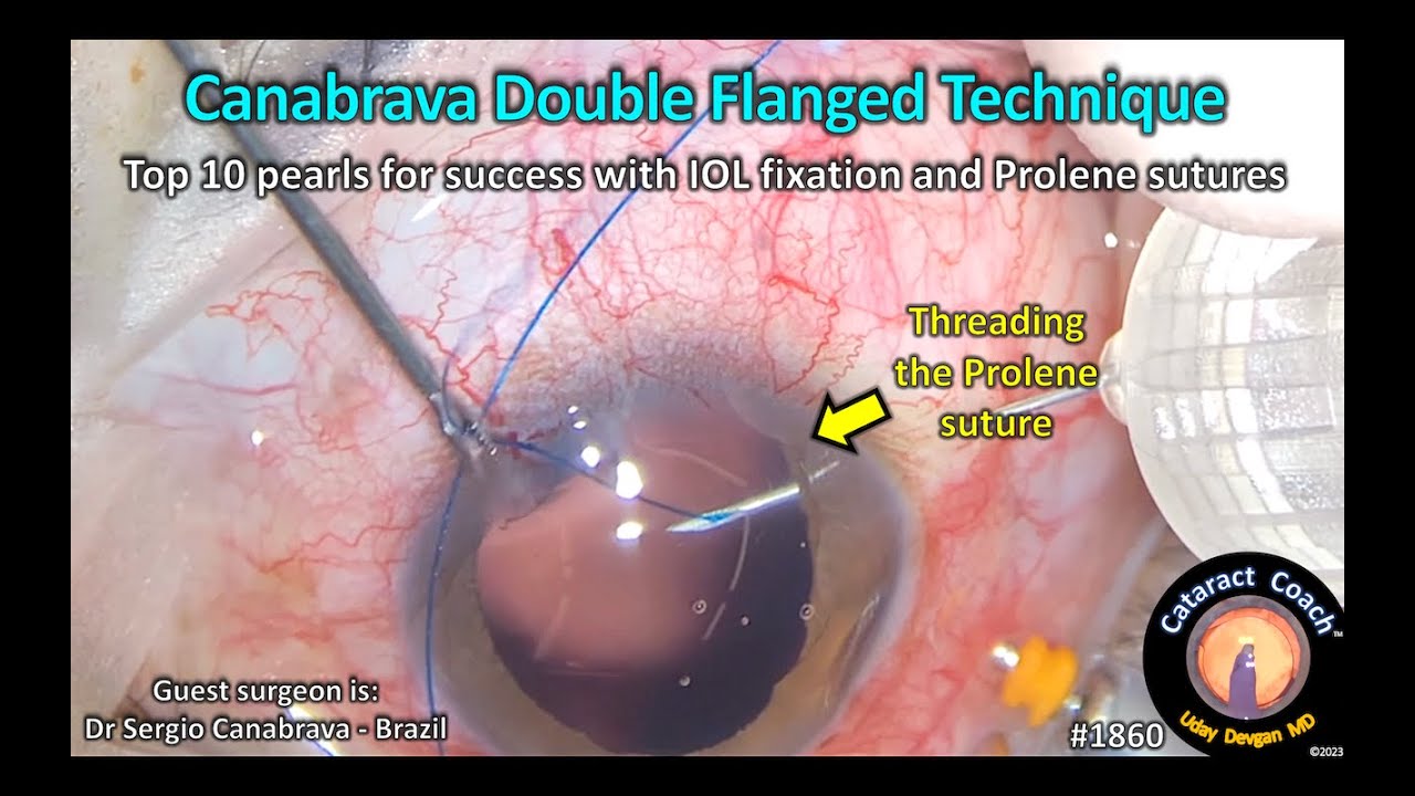 CataractCoach™ 1860: Canabrava double flanged technique for IOL ...